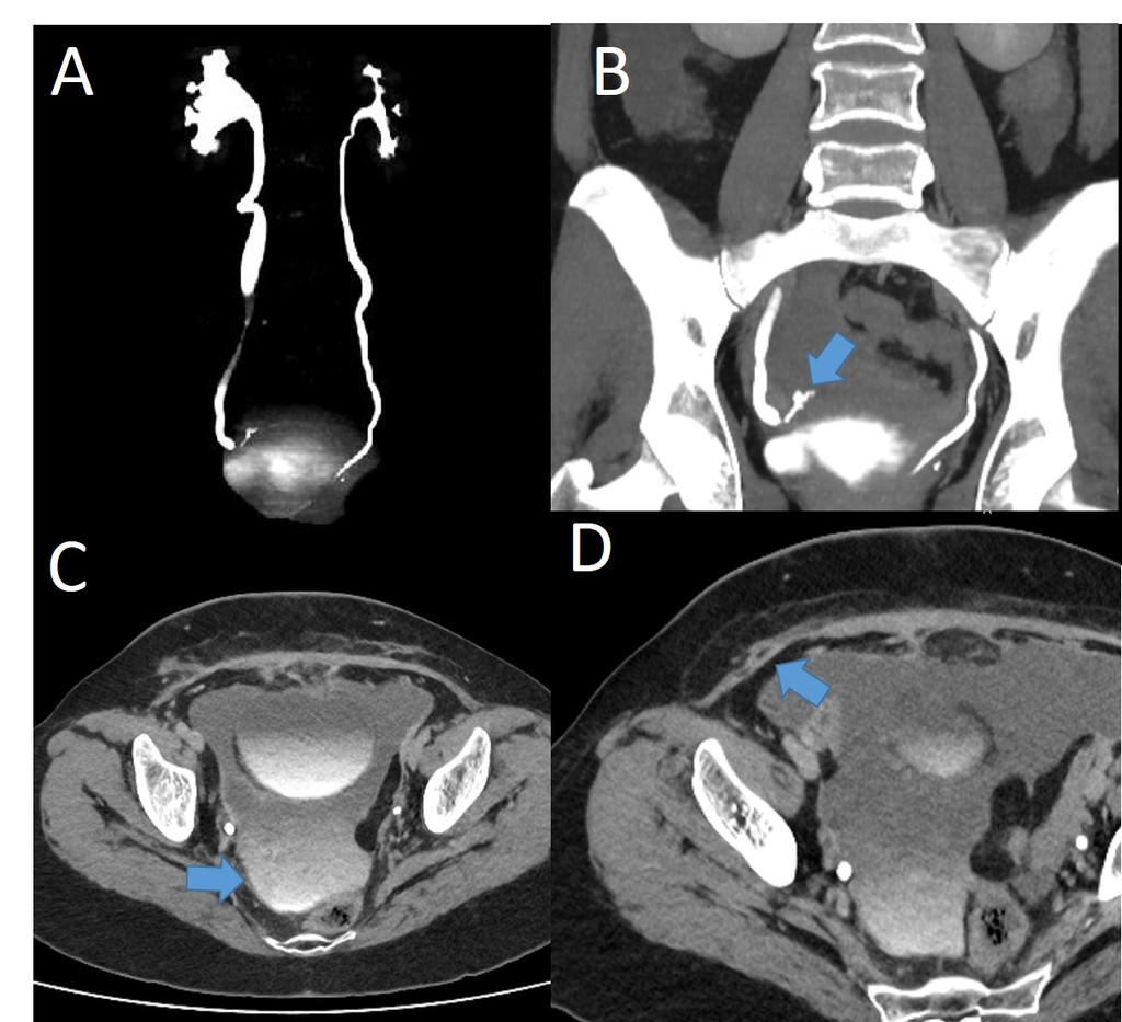 Lesão Ureteral Distal Durante Histerectomia Achados Da Tomografia